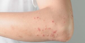 Infantigo (impétigo): causas, síntomas y tratamientos naturales más ...