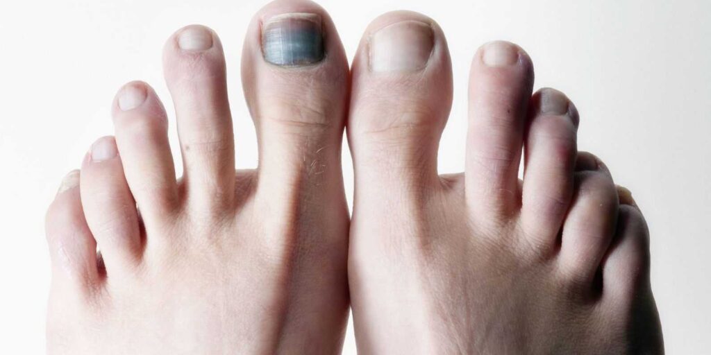 Magullado uñas de los pies: Causas, síntomas y tratamientos caseros ...