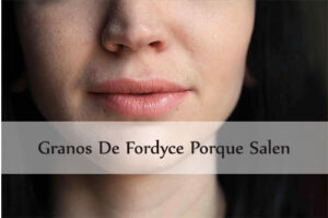 Las manchas de Fordyce en labios | Granos de fordyce : Causas, Síntomas ...